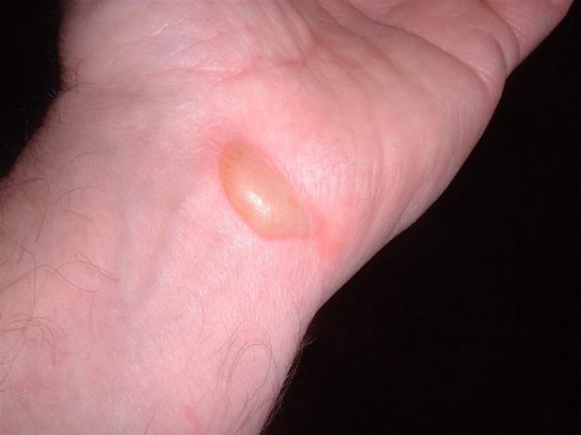 burns | MIG Welding Forum