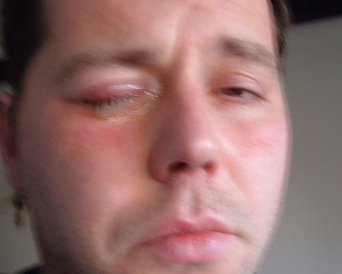 Worried about Arc eye | Page 2 | MIG Welding Forum